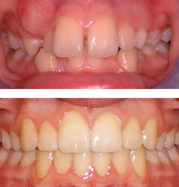 Before and After - Associates in Orthodontics | South Burlington Essex ...